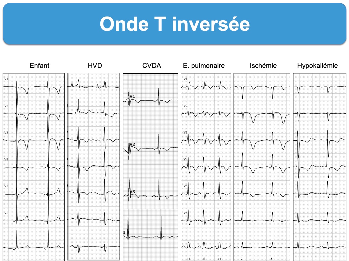 Ischémie sous-épicardique : e-cardiogram