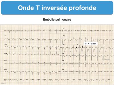 Onde T inversée : e-cardiogram