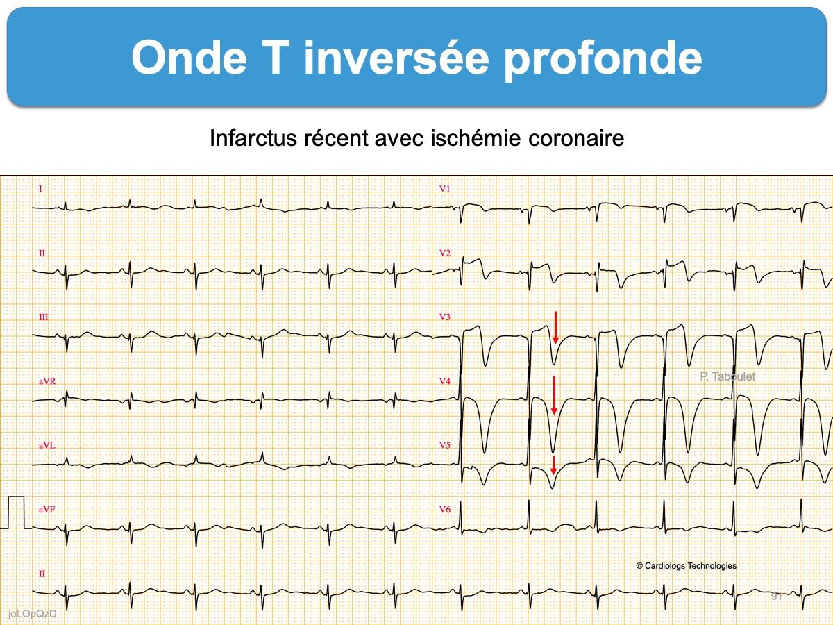 Onde T inversée : e-cardiogram