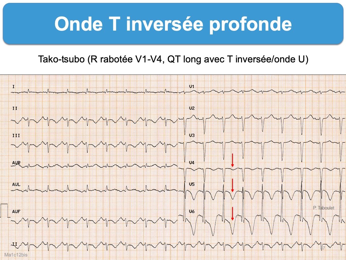Onde T inversée : e-cardiogram