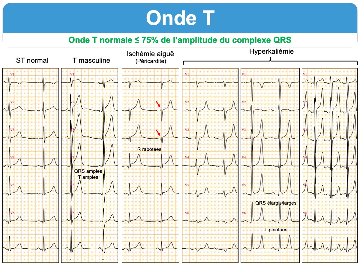 Onde T ample : e-cardiogram