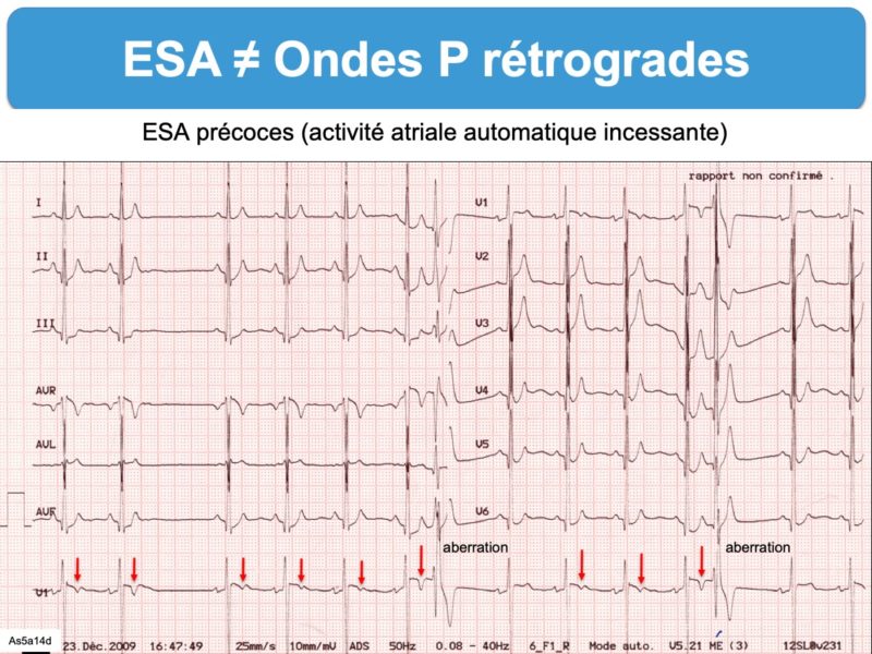 Onde P rétrograde : e-cardiogram