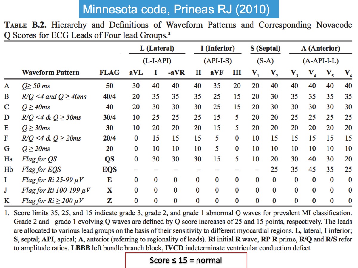 Onde Q : e-cardiogram