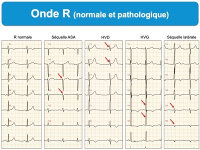 Onde R : e-cardiogram