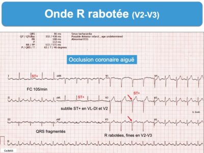 Progression harmonieuse des ondes R : e-cardiogram