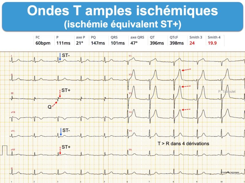 Onde T ample ischémique. x ECG : e-cardiogram