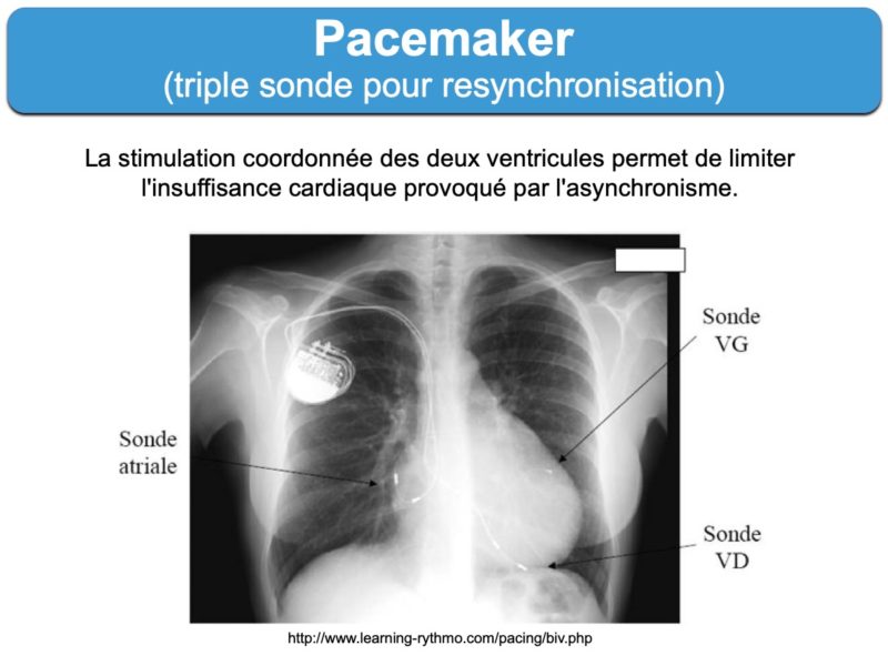 Pacemaker 4. Fonctions complexes : e-cardiogram
