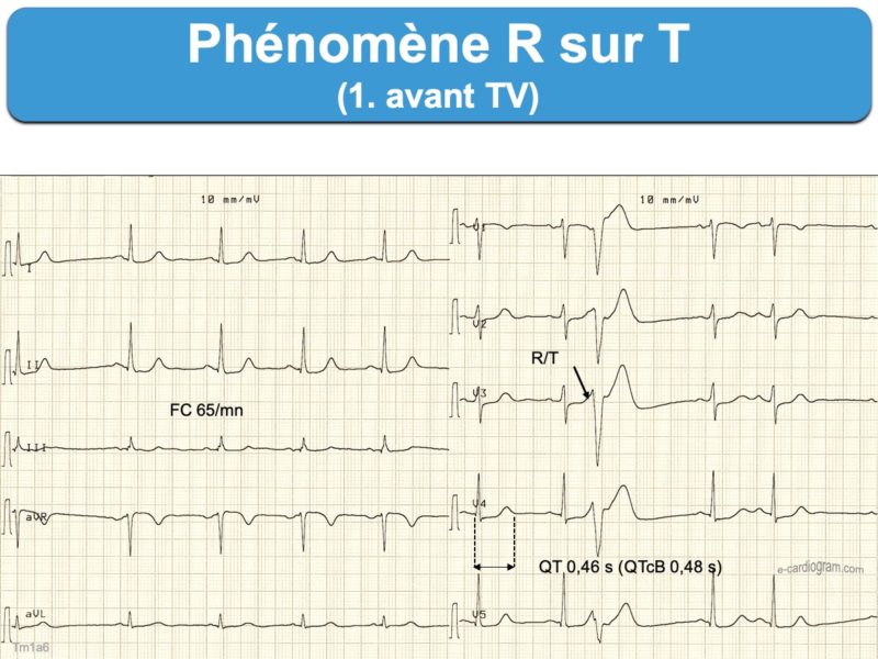 Phénomène R sur T : e-cardiogram