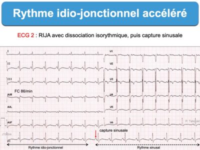 Pacemaker 1. Physiologique : e-cardiogram