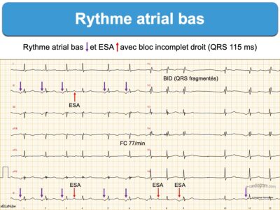 Rythme du sinus coronaire : e-cardiogram
