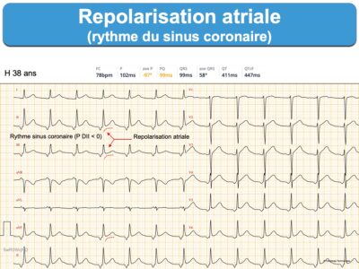 Rythme du sinus coronaire : e-cardiogram