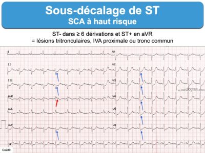 Sous-décalage du ST : e-cardiogram