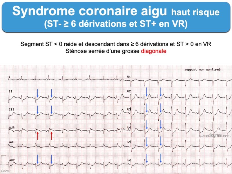 SCA 3c. non ST+ avec ST+ VR : e-cardiogram