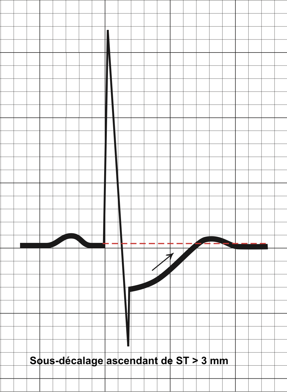 Segment ST (ou segment JT) : e-cardiogram