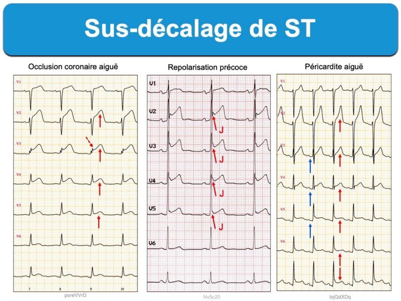 Sus-décalage de ST : généralités : e-cardiogram