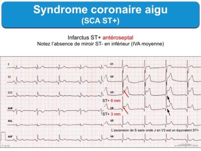 SCA 2a. ST+ (3 critères) : e-cardiogram