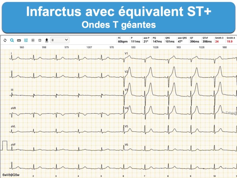 SCA 3b. Non ST+ équivalents ST+ : e-cardiogram