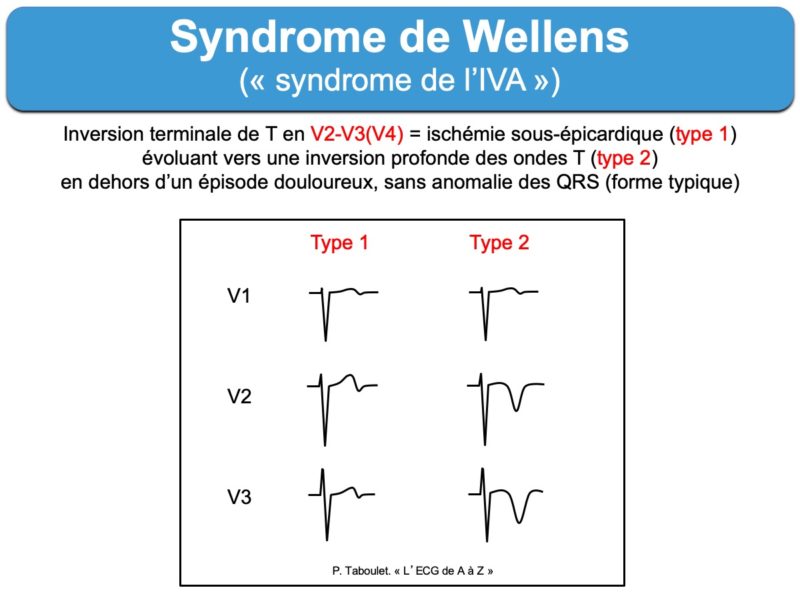 Syndrome de Wellens : e-cardiogram