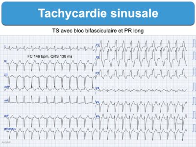 Tachycardie sinusale : e-cardiogram