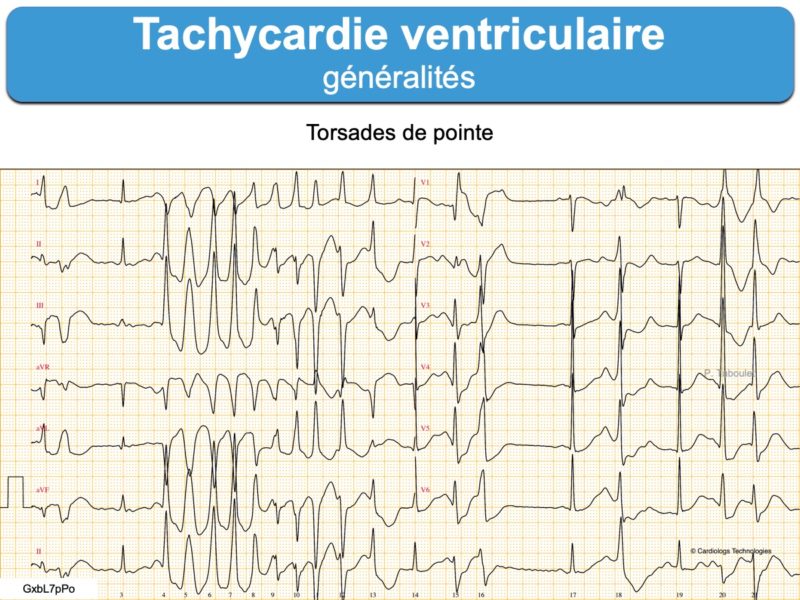 TV 1a. tachycardies ventriculaires : e-cardiogram