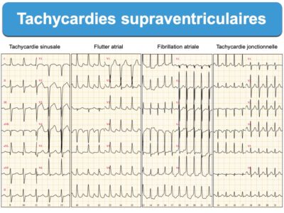 Tachycardies supraventriculaires (TSV) : e-cardiogram