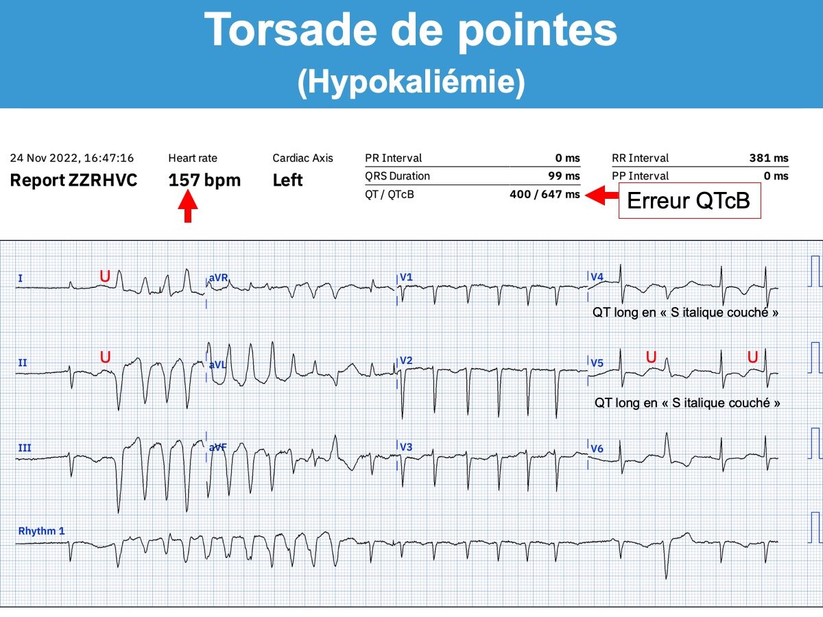 Torsade de pointes : e-cardiogram
