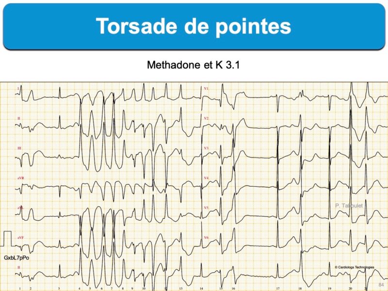 Torsade de pointes : e-cardiogram