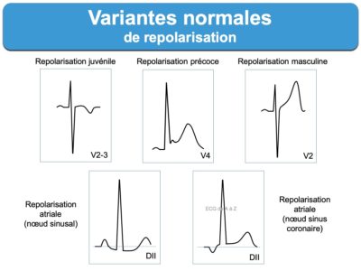 Variantes repolarisation ventriculaire : e-cardiogram
