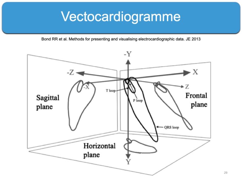 Vectocardiographie : e-cardiogram