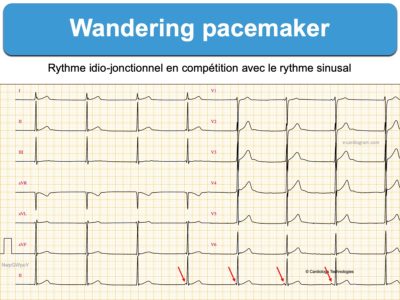 Wandering pacemaker (WPM) : e-cardiogram
