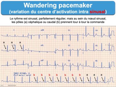 Wandering pacemaker (WPM) : e-cardiogram