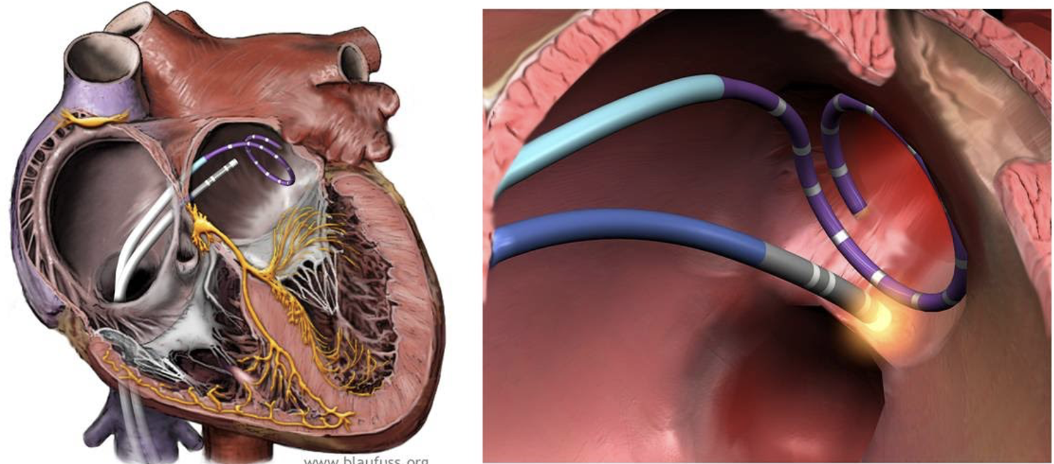 Ablation de FA ou flutter. Technique : e-cardiogram
