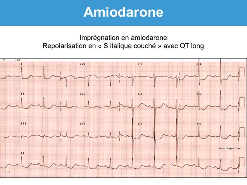 Amiodarone : e-cardiogram