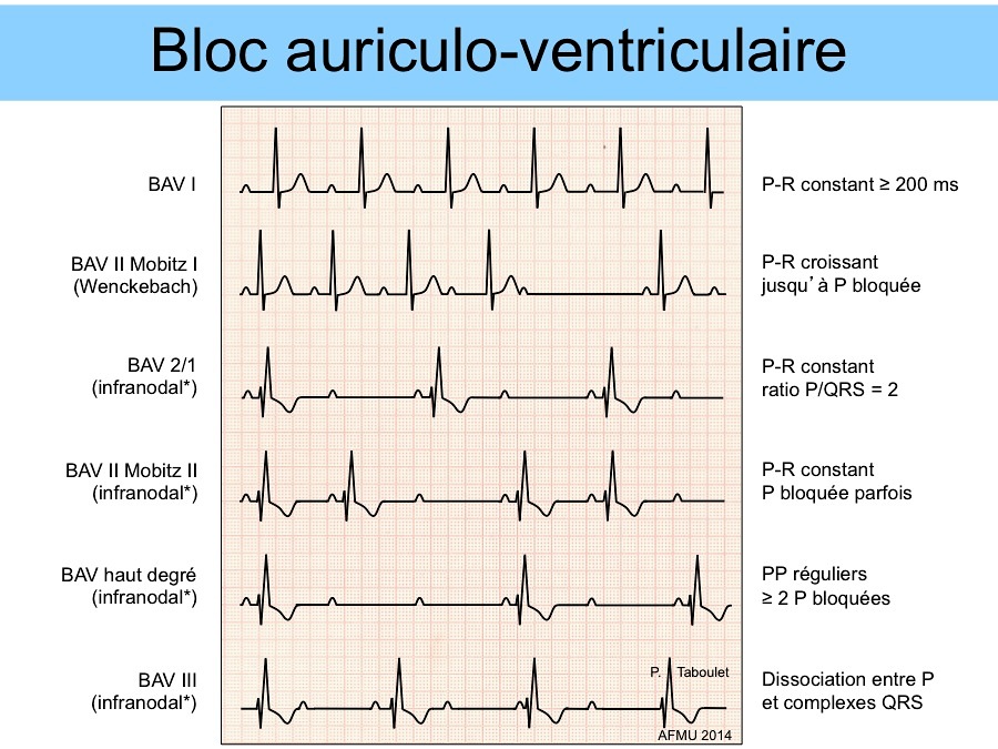 Bloc auriculo-ventriculaire : e-cardiogram