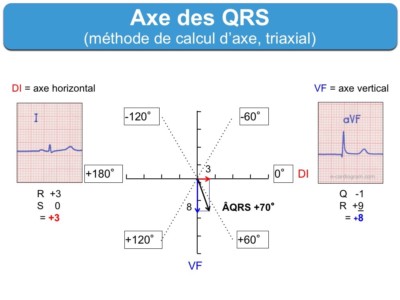Axe des QRS : e-cardiogram