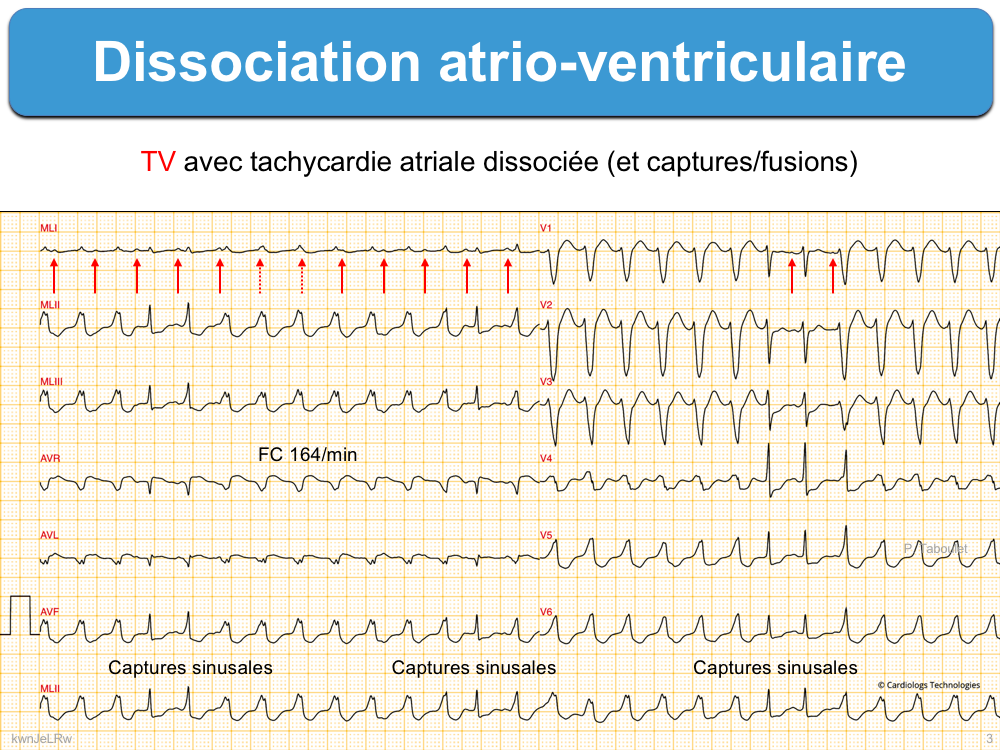 Capture sinusale : e-cardiogram
