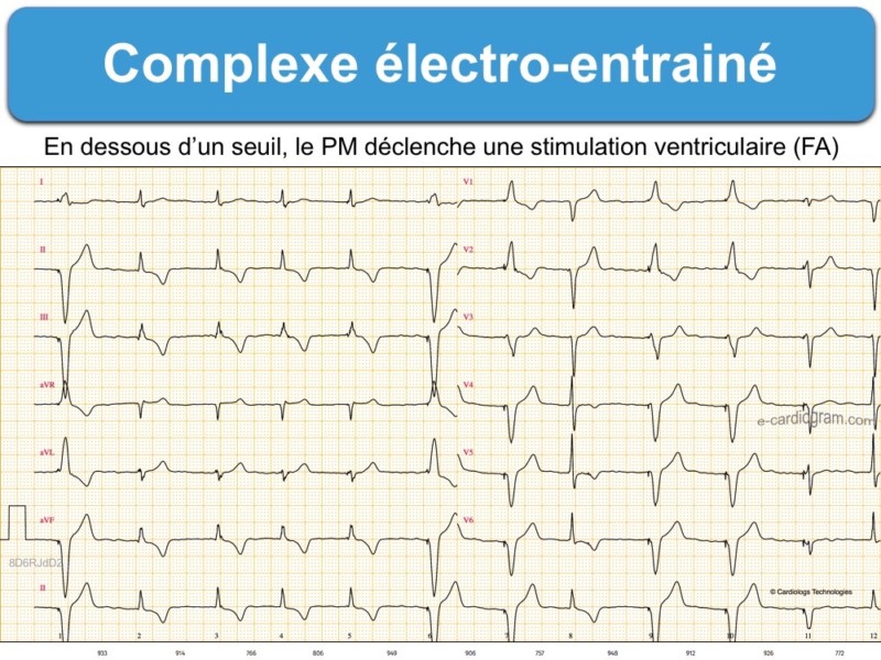 Complexe électro-entraîné : e-cardiogram