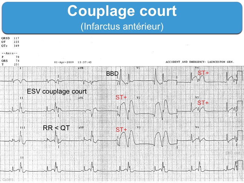 Couplage : e-cardiogram
