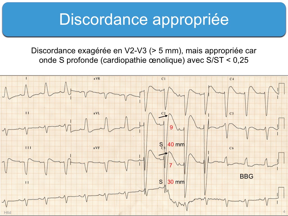 Discordance appropriée : e-cardiogram