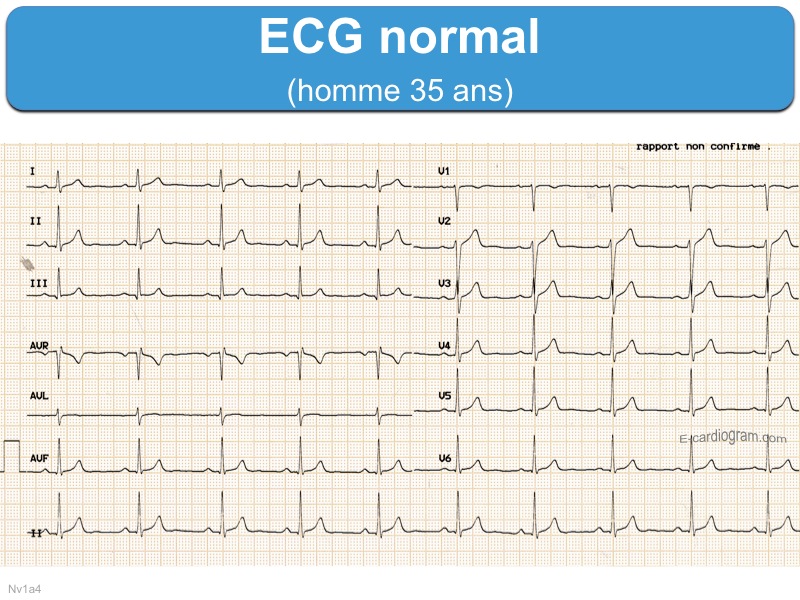 ECG : normal : e-cardiogram
