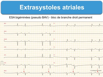 Extrasystole atriale : e-cardiogram