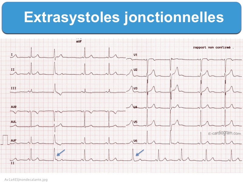 Extrasystole jonctionnelle : e-cardiogram