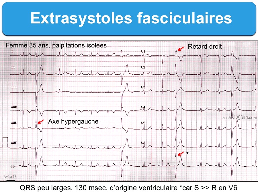 Extrasystole Fasciculaire E cardiogram Extrasystole Fasciculaire E cardiogram