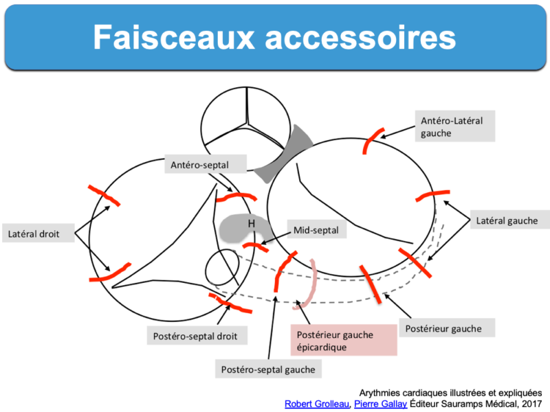 Faisceau accessoire : e-cardiogram