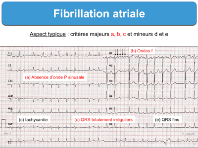 Fibrillation atriale 2. diagnostic ECG : e-cardiogram
