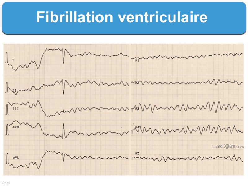 Fibrillation ventriculaire : e-cardiogram