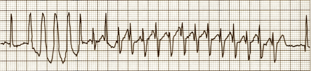 Complexes QRS aberrants/ectopiques : e-cardiogram