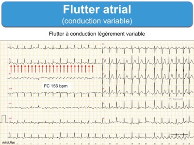 Flutter atrial 1. Généralités : e-cardiogram