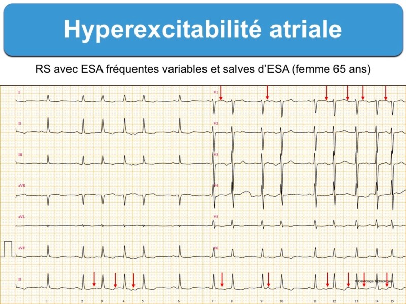 Extrasystole atriale : e-cardiogram