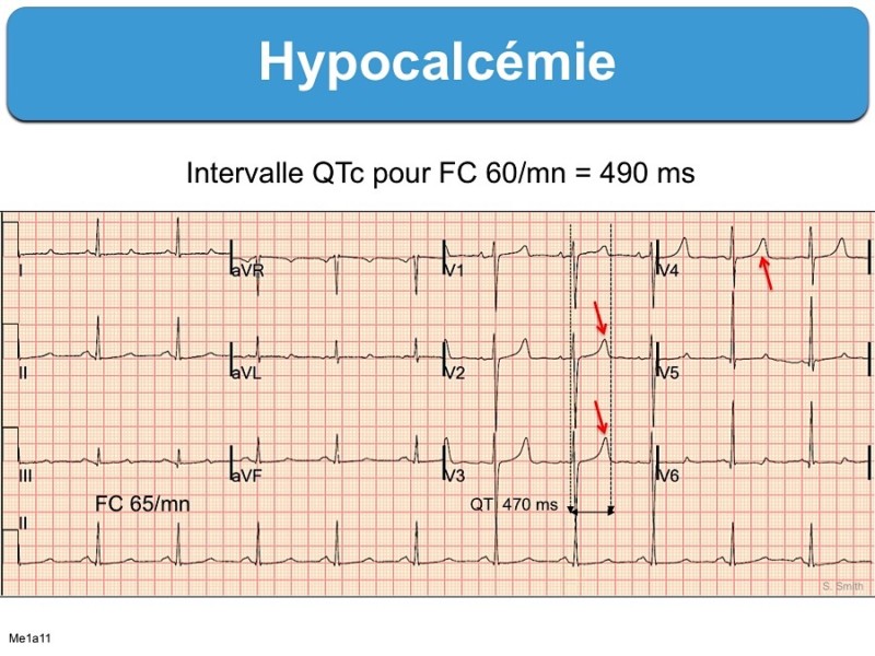Hypocalcémie : e-cardiogram